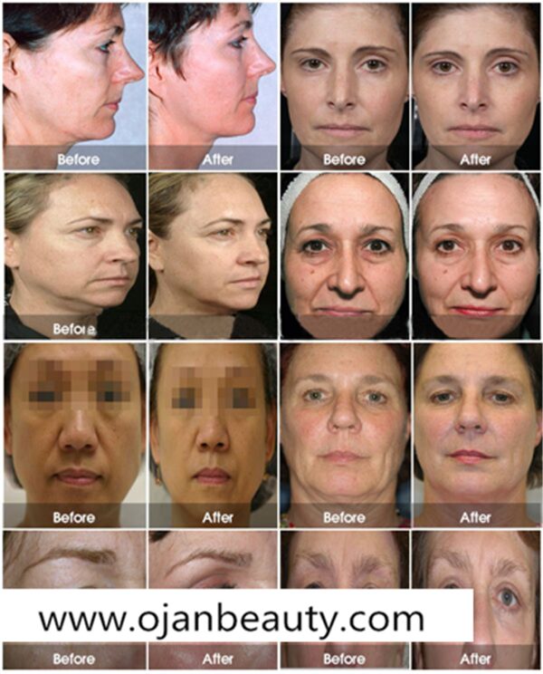 HIFU Facial Before And After – Is HIFU Facial Worth It? - OJAN Beauty ...