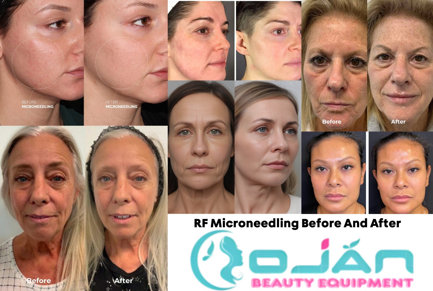 RF Microneedling Before And After – See The Incredible Results In 2025 ...