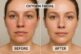 What Is an Oxygen Facial Machine? Benefits, Working Process & Results ...
