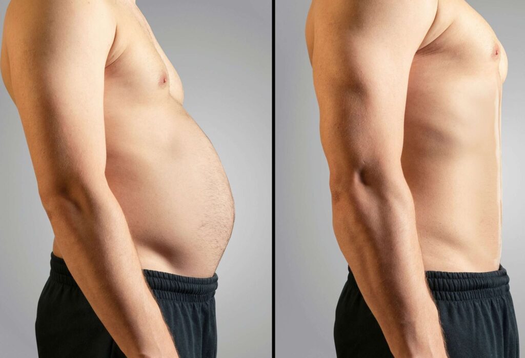 CoolSculpting Vs Liposuction: 9 Expert-Backed Differences Explained ...