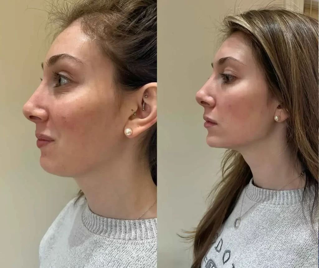 Body Contouring Before and After: Real Results & Expert Insights (2026 ...